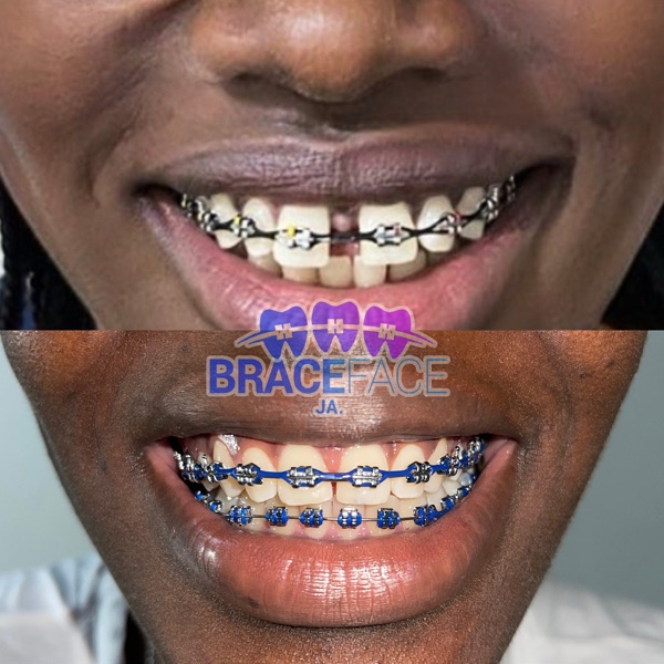 🧚🏽‍♀️🦷 Braceface.ja... | Book Your Appointment Online Now